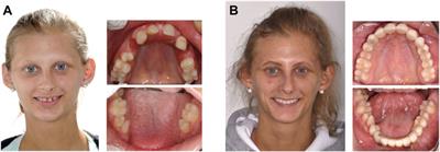 Frontiers | Ectodermal dysplasias: New perspectives on the treatment of so far immedicable ...